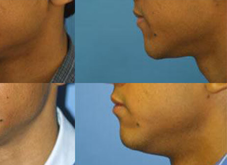 Facial Plastic Surgeon | Rhinoplasty Nose Jobs New York | NYC Dr. Miller