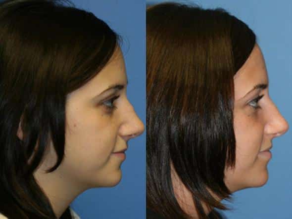 Five Top Common Nose Shapes with Photos - Philip Miller MD