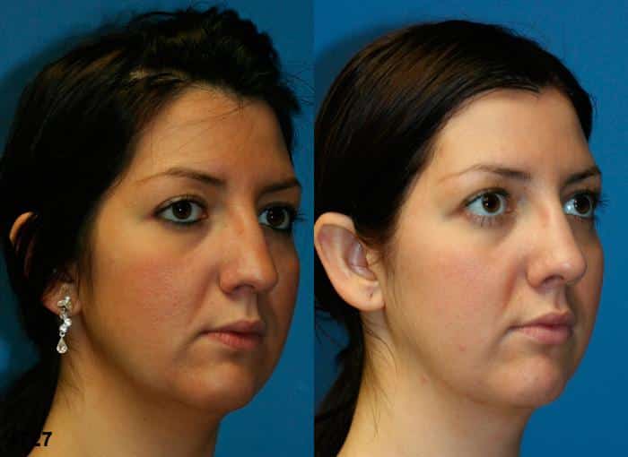 Five Top Common Nose Shapes with Photos - Philip Miller MD