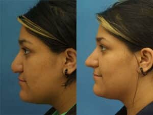 Tip Drop After Rhinoplasty - Philip Miller MD