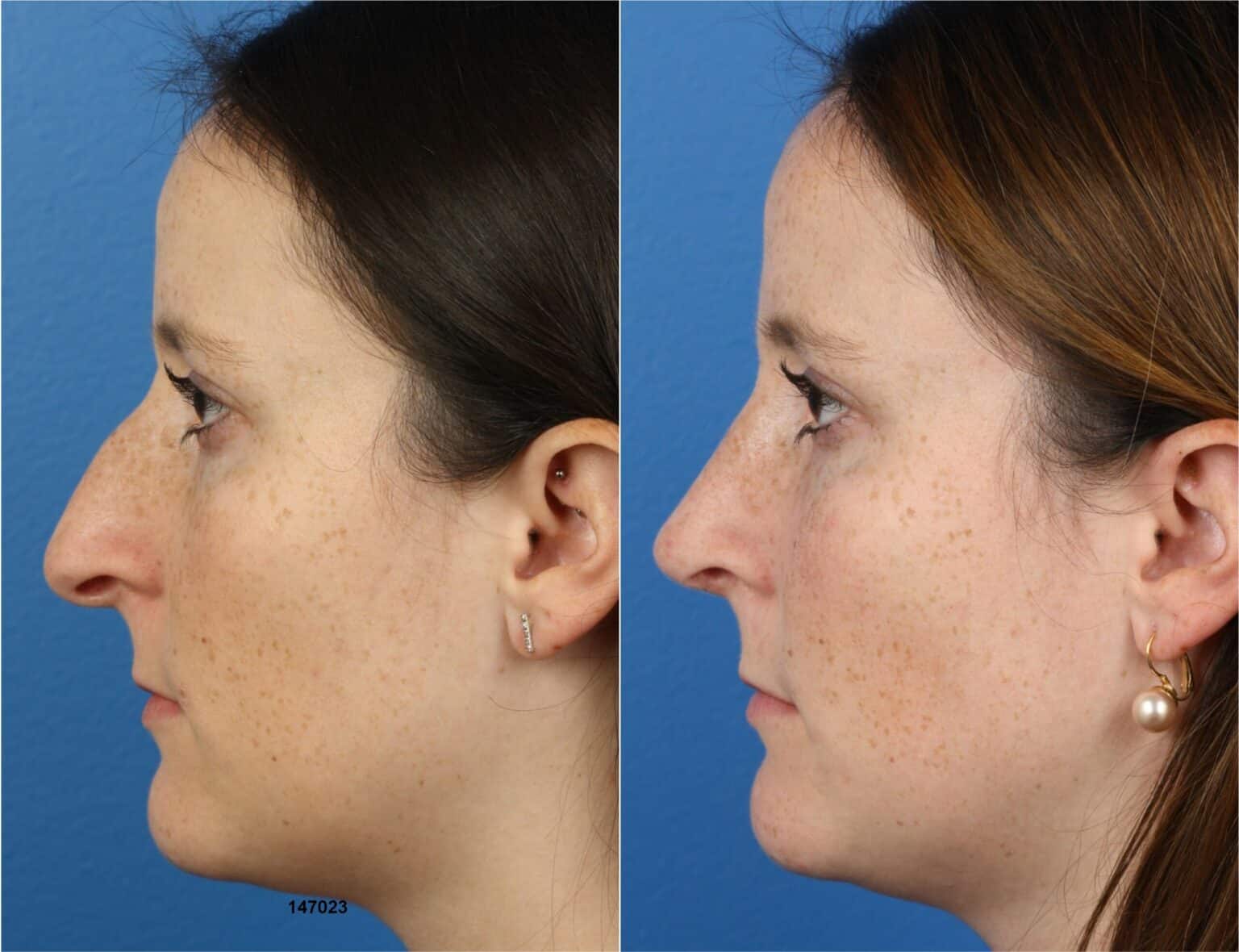 Will Scar Tissue Be an Issue After Rhinoplasty? - Philip Miller MD