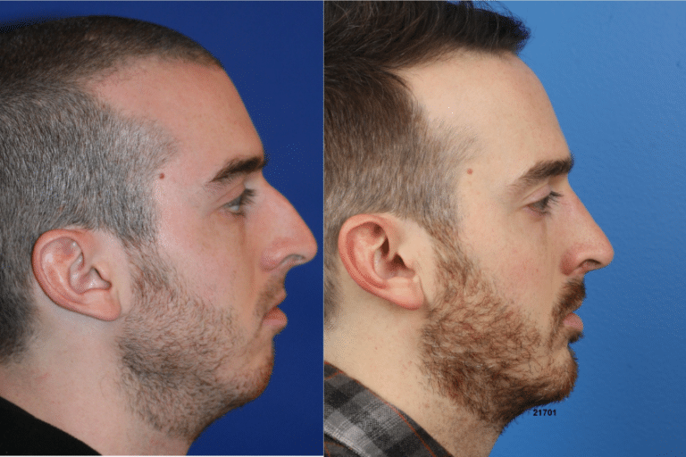 When to Choose a Nose Tip Surgery Over Full Rhinoplasty? - Philip Miller MD