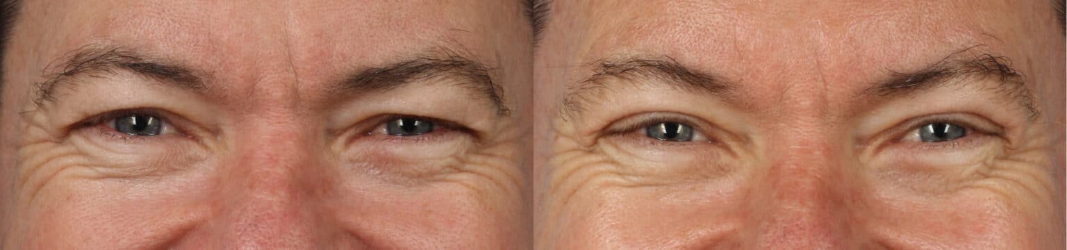 What Age is Normal to Get Wrinkles? - Philip J. Miller, MD | Facial ...