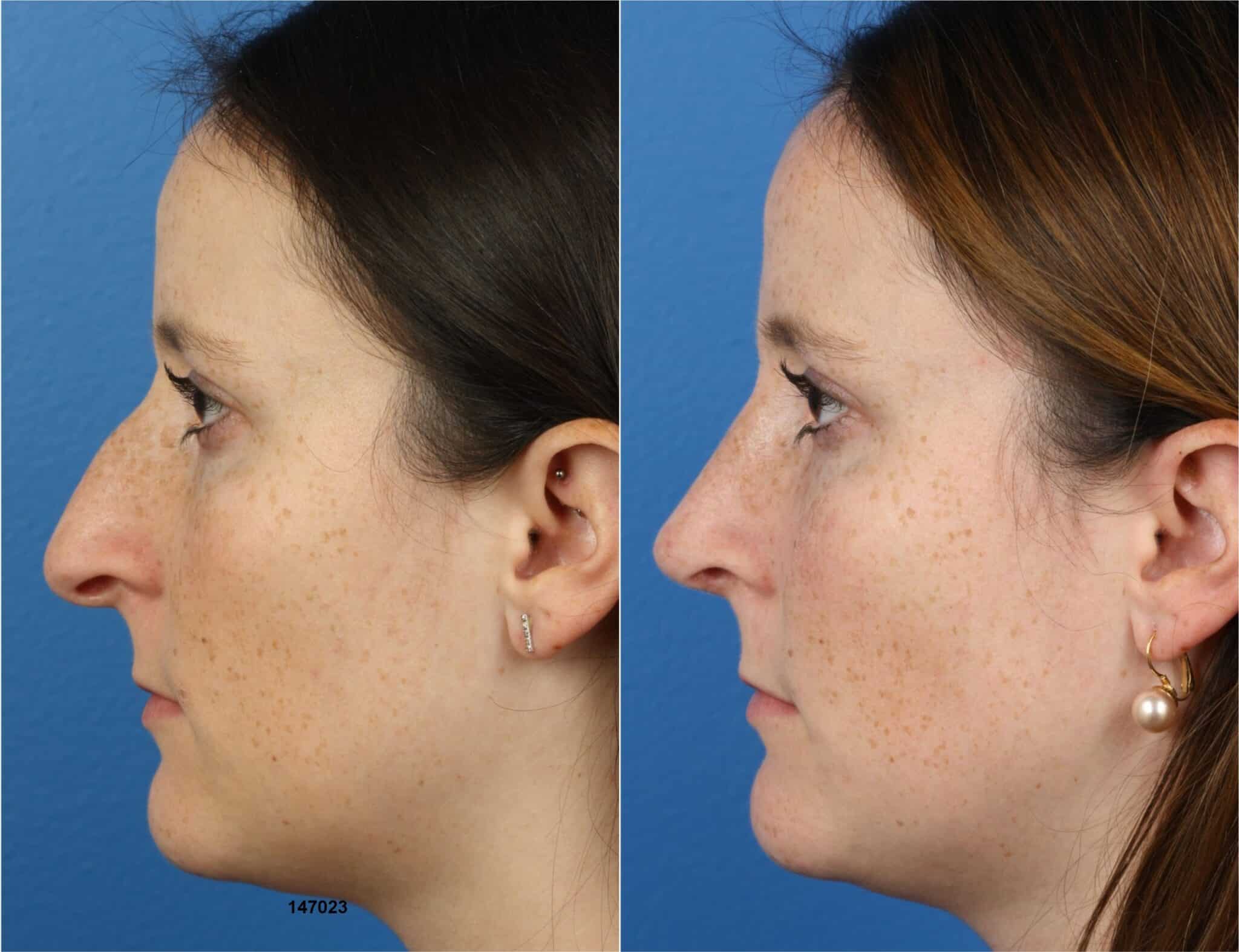 When to Choose a Nose Tip Surgery Over Full Rhinoplasty? - Philip Miller MD