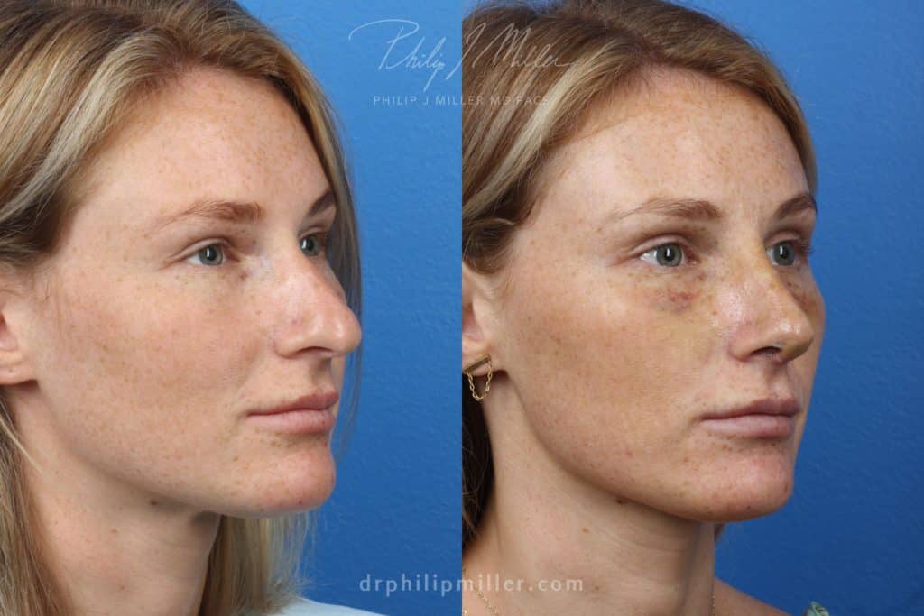 One Anti-Aging Procedure You Wouldn't Expect, Rhinoplasty - Philip ...