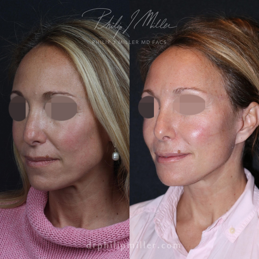 Facial Plastic Surgeon | New York Rhinoplasty | Dr. Miller