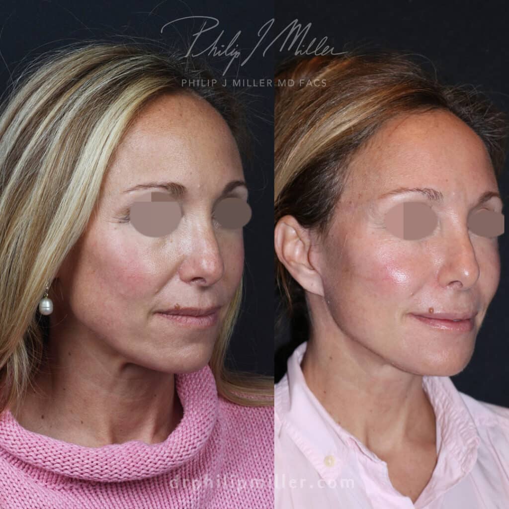 Facelift Options, 20+ Yrs. Exp. New York City, NY | Dr. Philip Miller