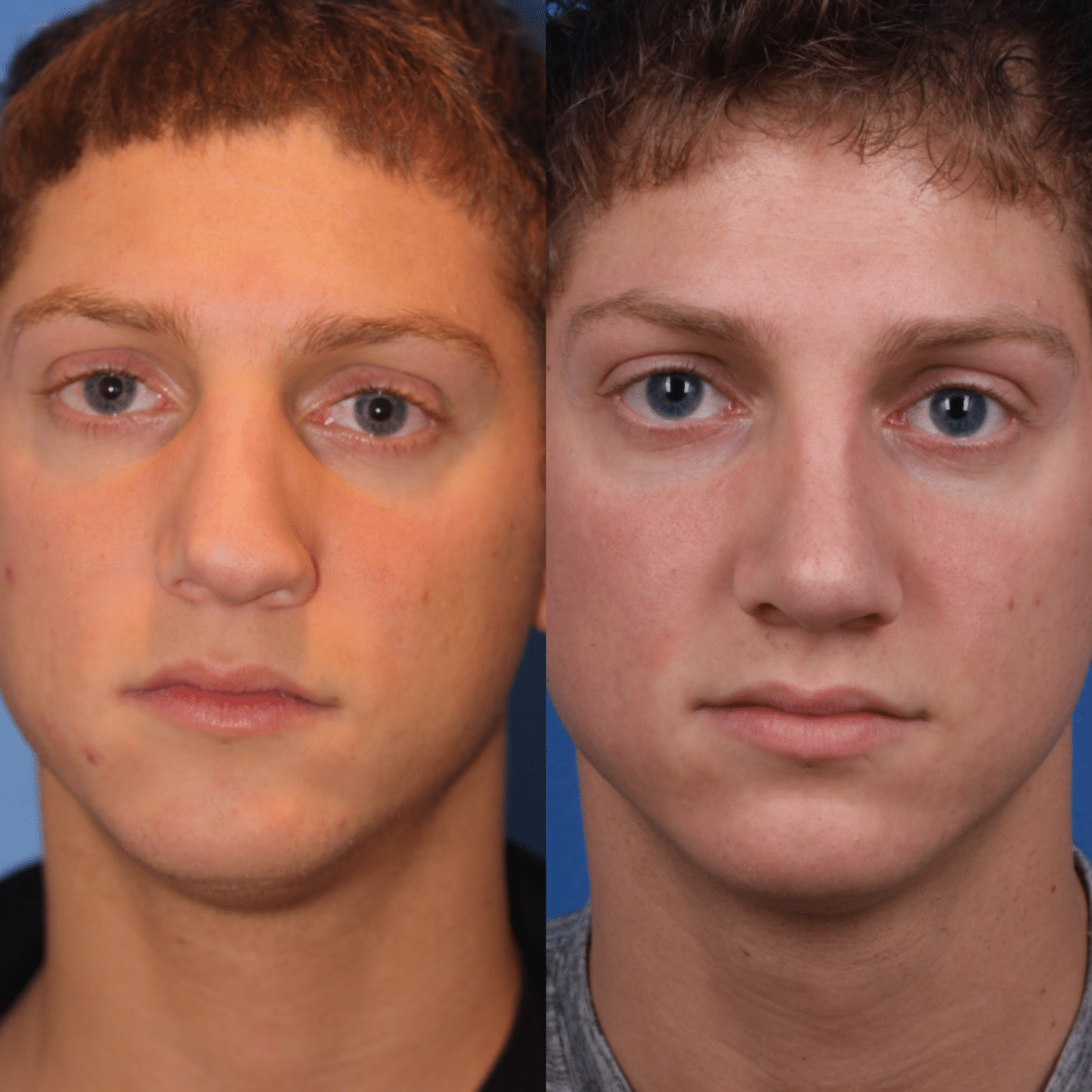 Revision Rhinoplasty Case Study | Best Surgeon NYC
