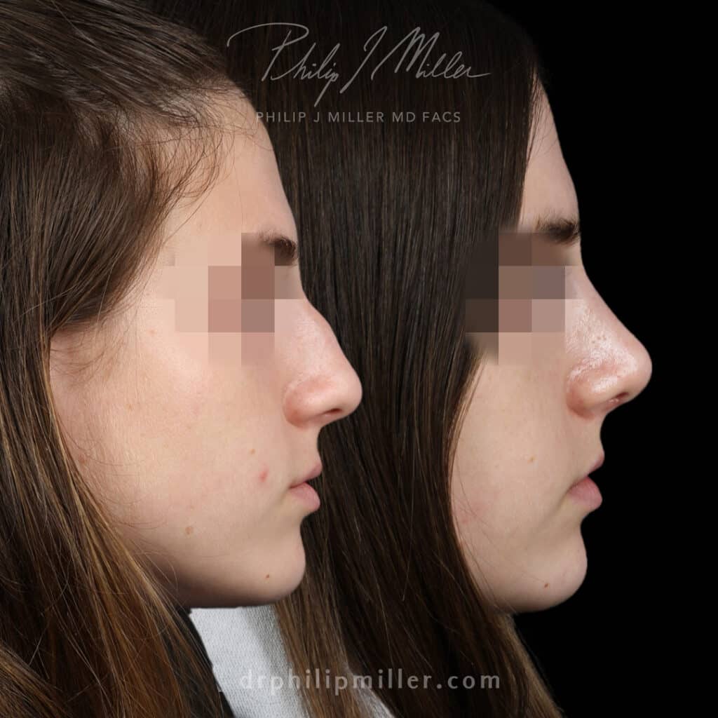 MicroRhinoplasty New York City, New York | Dr. Philip Miller